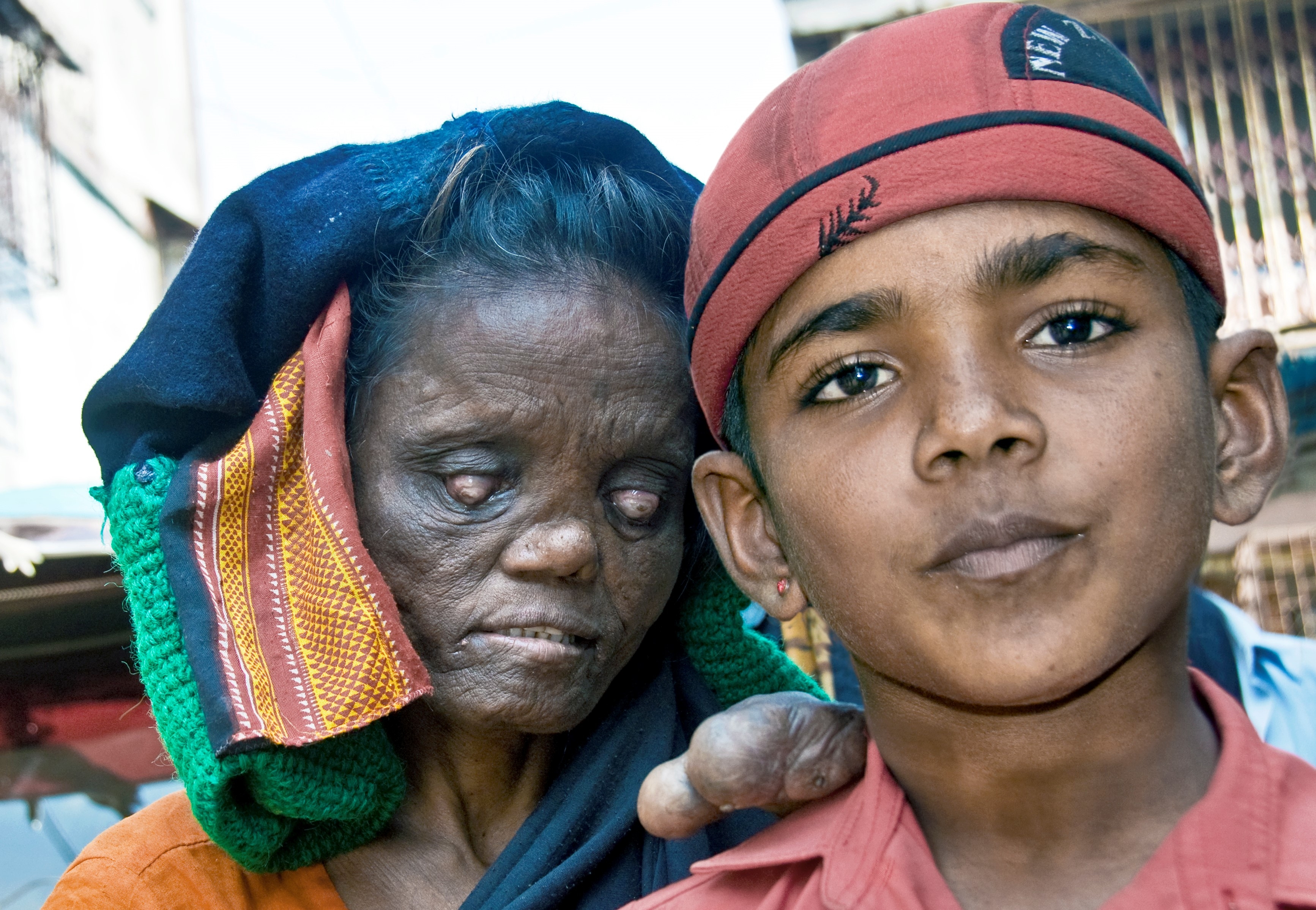 NYU Doctor: Leprosy Could Hit L.A.'s Homeless Population, 'Only a ...